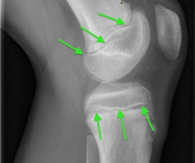 Knee Pain In Kids: What You Need To Know! – Marlborough Podiatry