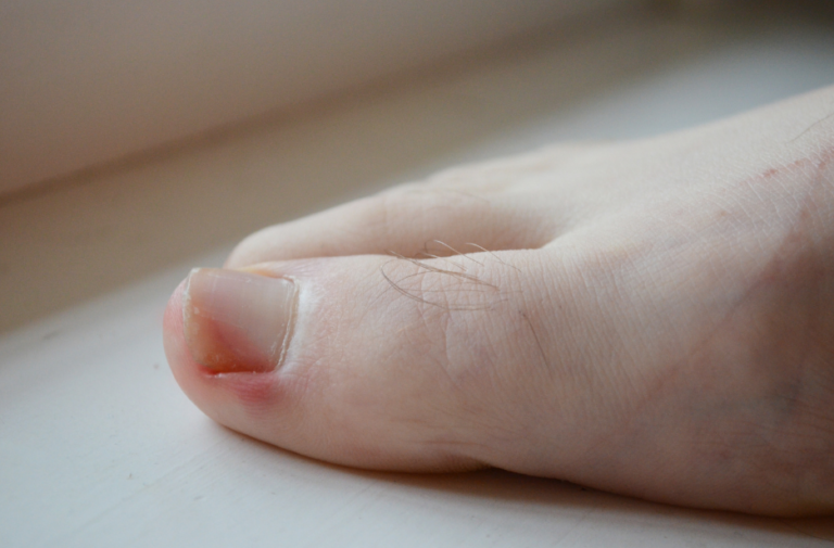 Ingrown Toenails: Infections, Prevention & Treatment – Marlborough Podiatry